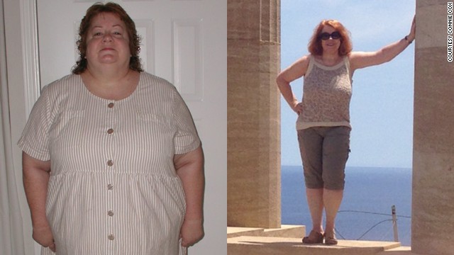 Bariatric surgery isn't 'one size fits all' - CNN.com Bariatric surgery isn't 'one size fits all' - CNN.com